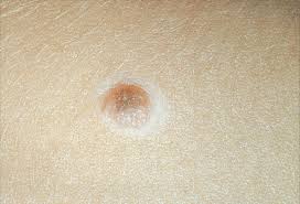Halo Nevus May Be Causing Your Atypical Mole - Skin Site