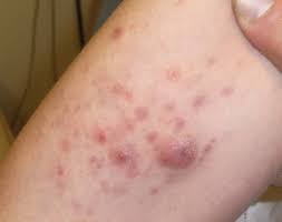 Lymphomatoid Papulosis Can Become Cancerous in Rare Cases