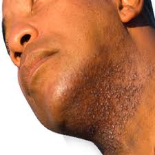 Have Razor Bumps? Here's What You Can Do About It