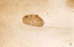 Are Seborrheic Keratosis Skin Growths Harmless or Should I Worry?